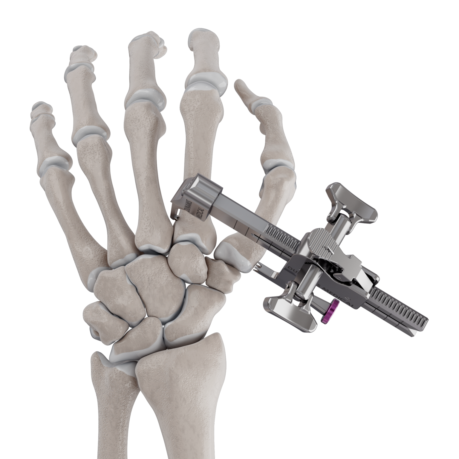 Micro Constrictor® for CMC Arthroplasty Repair | Dunamis Medical