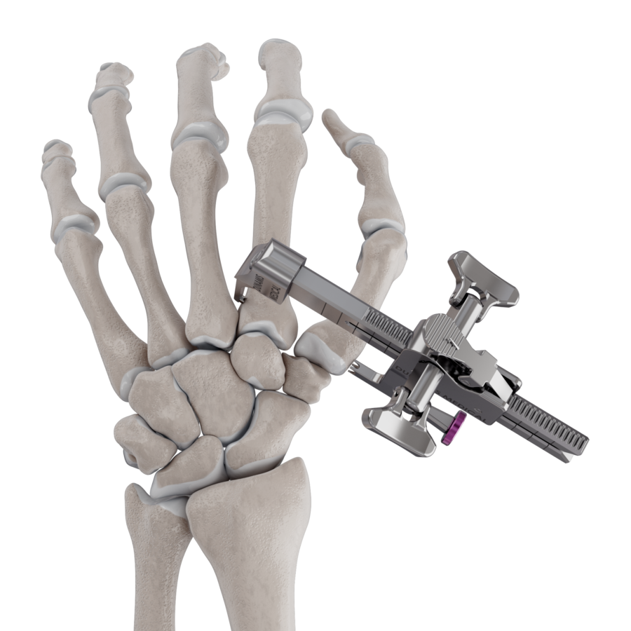 Micro Constrictor® for CMC Arthroplasty Repair | Dunamis Medical