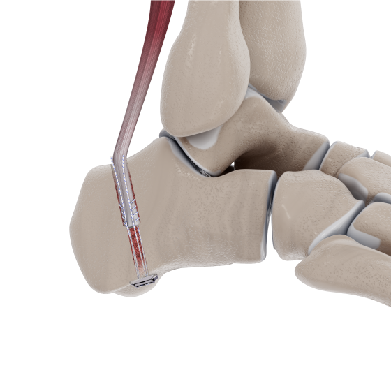 Chronic Achilles- FHL Tendon Transfer Knotless adjustable button - Dunamis Medical