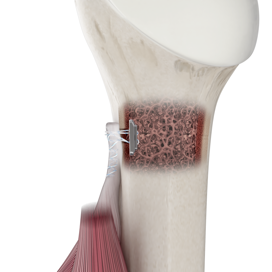 ORCA Xtreme – Knotless Tendon Repair - Upper Extremity - Dunamis Medical