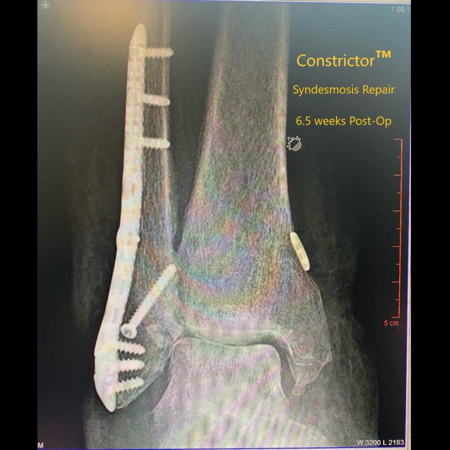 Constrictor® Implantation Image Gallery | Dunamis Medical®
