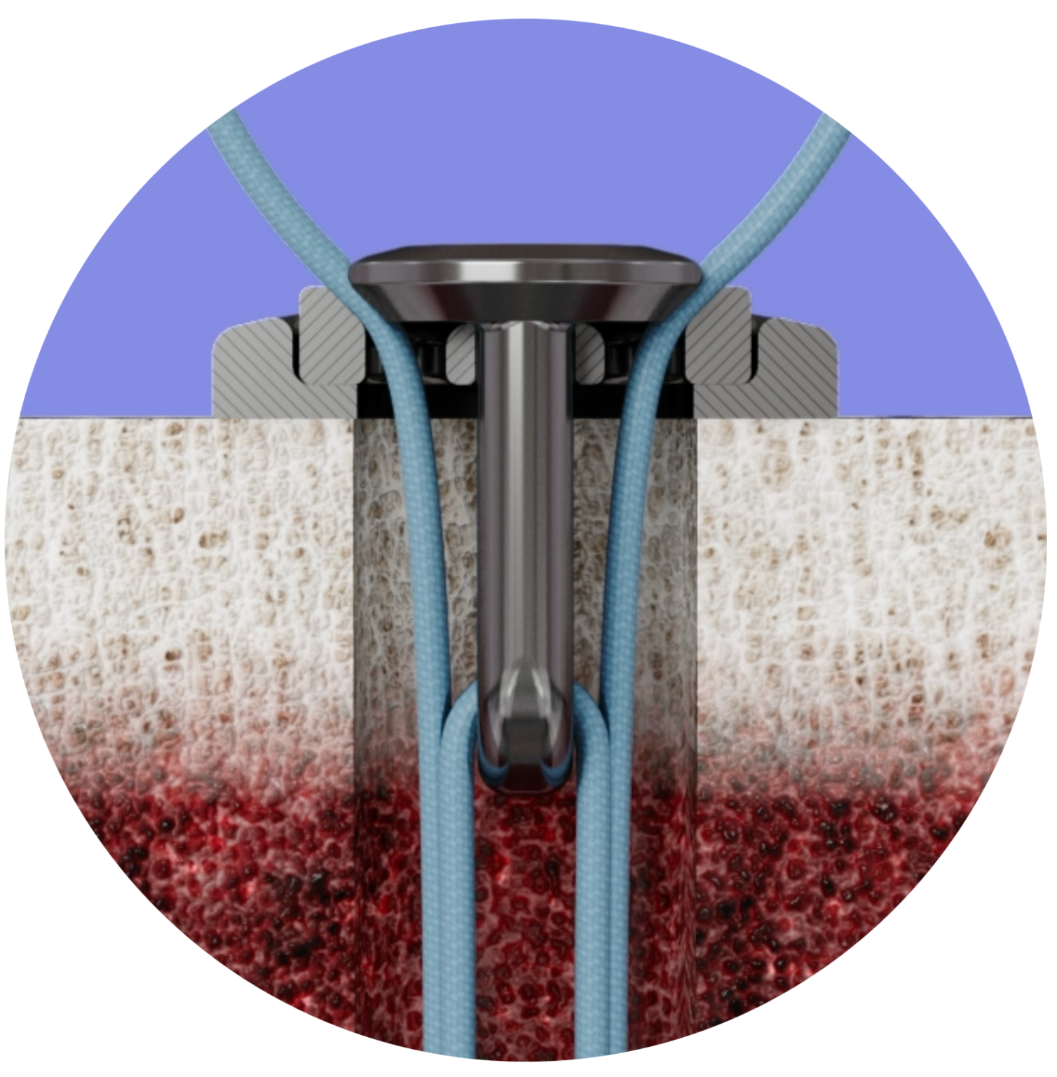 Constrictor-mini-snare-with-extender-button - Dunamis Medical