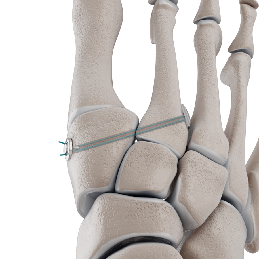 Constrictor® Mini Snare for Lisfranc Repair