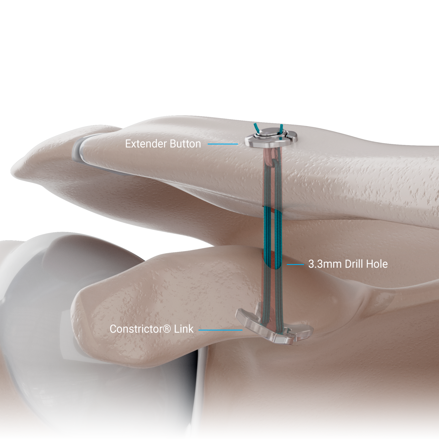 Constrictor® Mini Snare - Dunamis Medical