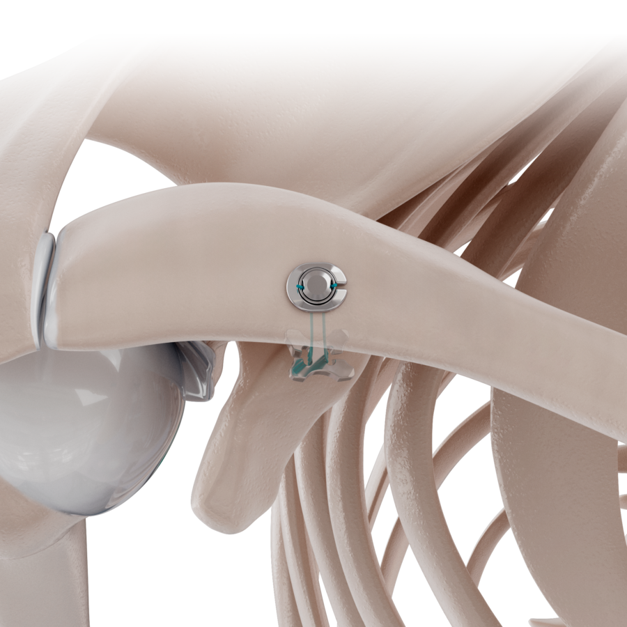 Constrictor® Mini Snare - Dunamis Medical