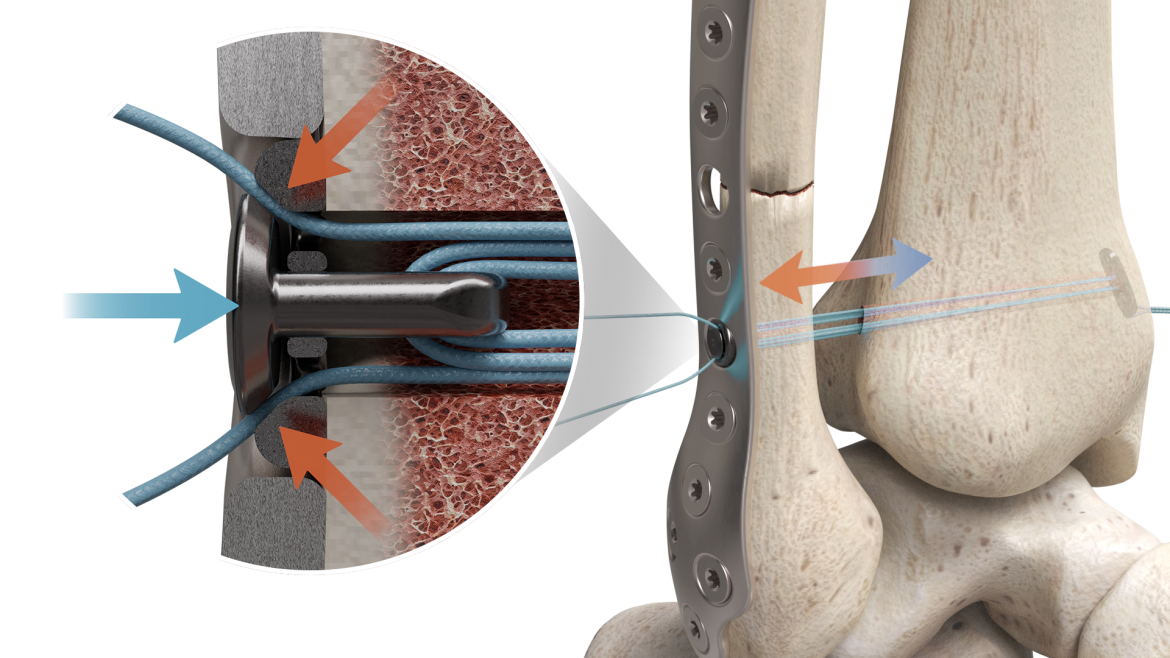Cross-Section copy - Dunamis Medical