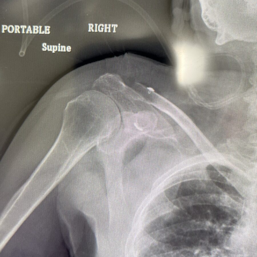 Constrictor® Implantation Image Gallery | Dunamis Medical®