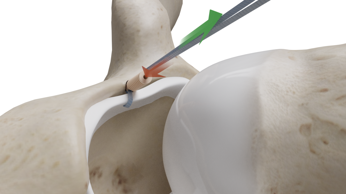 Labrum-1 copy - Dunamis Medical