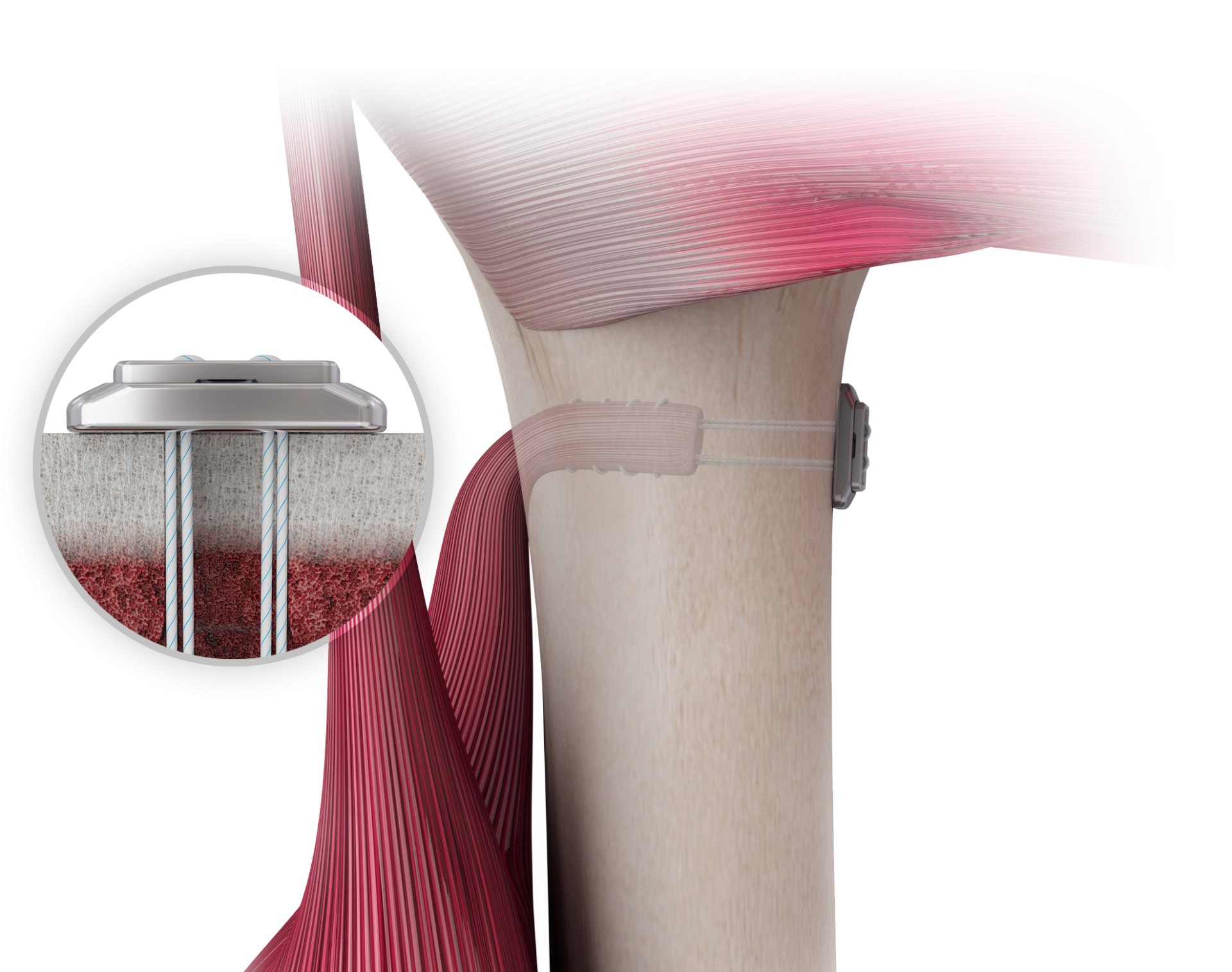 ORCA™ – Knotless Tendon Repair - Upper Extremity - Dunamis Medical