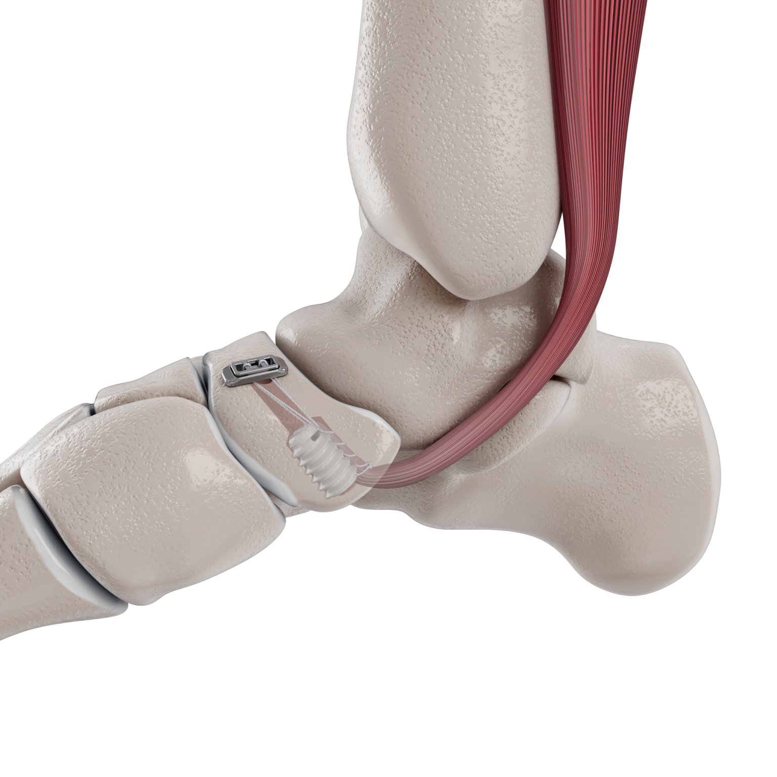 Introducing the TenoTrap™ Screw System - Dunamis Medical