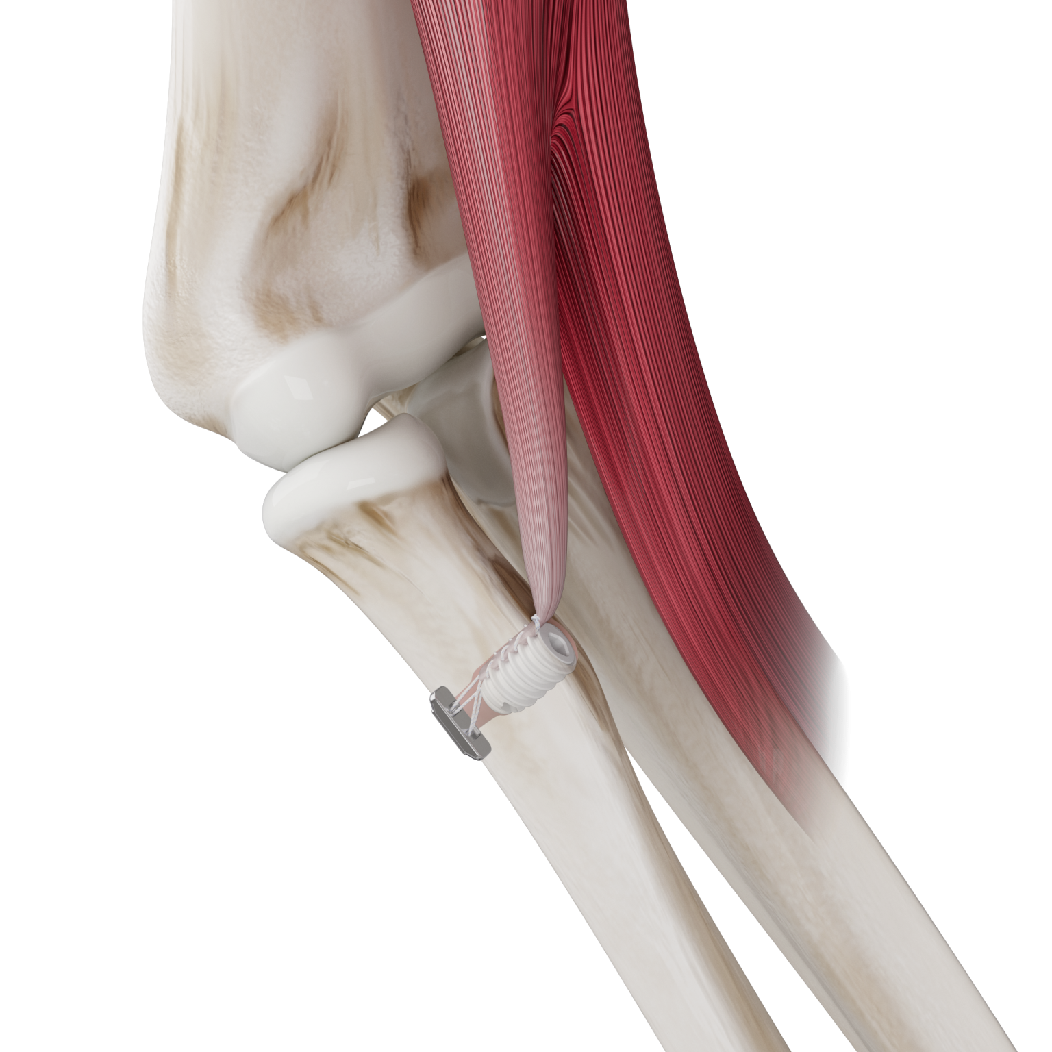 Introducing the TenoTrap™ Screw System - Dunamis Medical