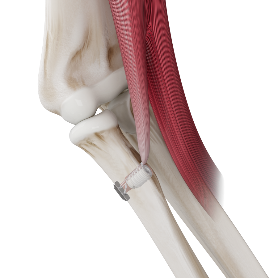 Introducing the TenoTrap™ Screw System - Dunamis Medical