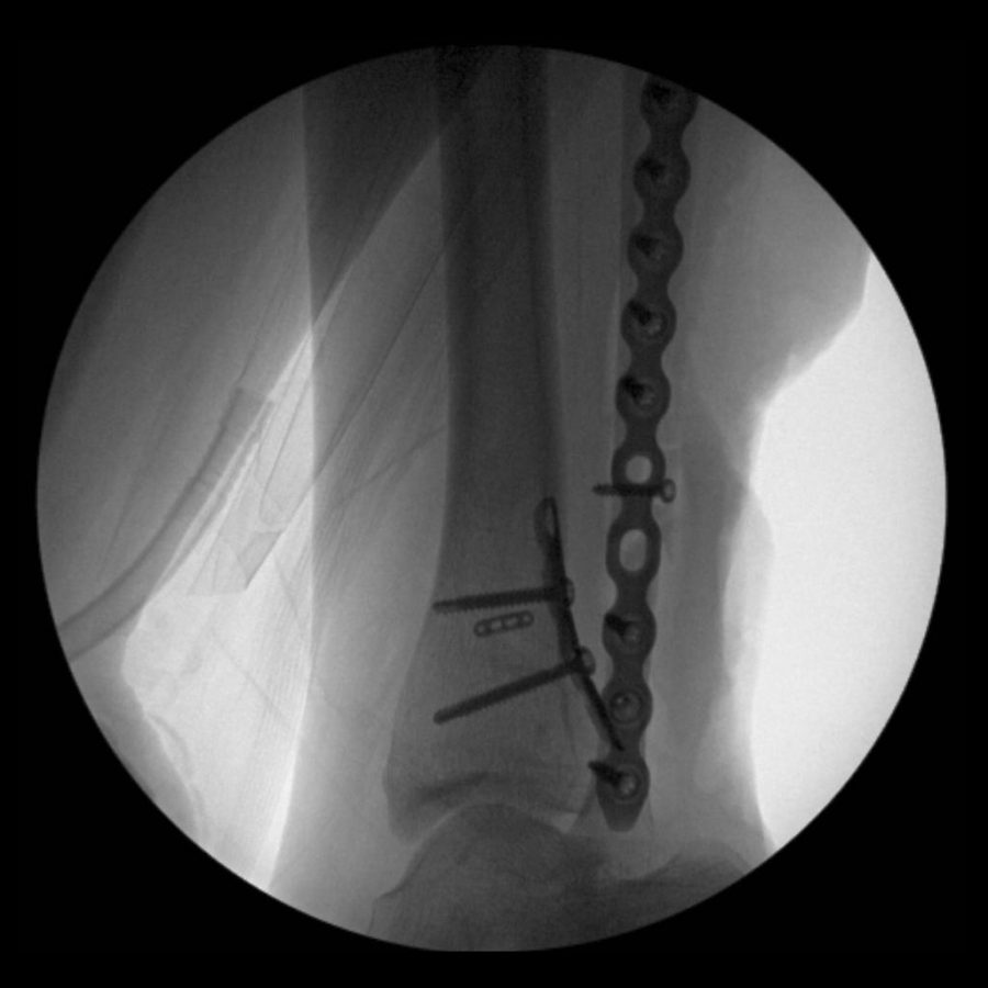 Constrictor® Implantation Image Gallery | Dunamis Medical®