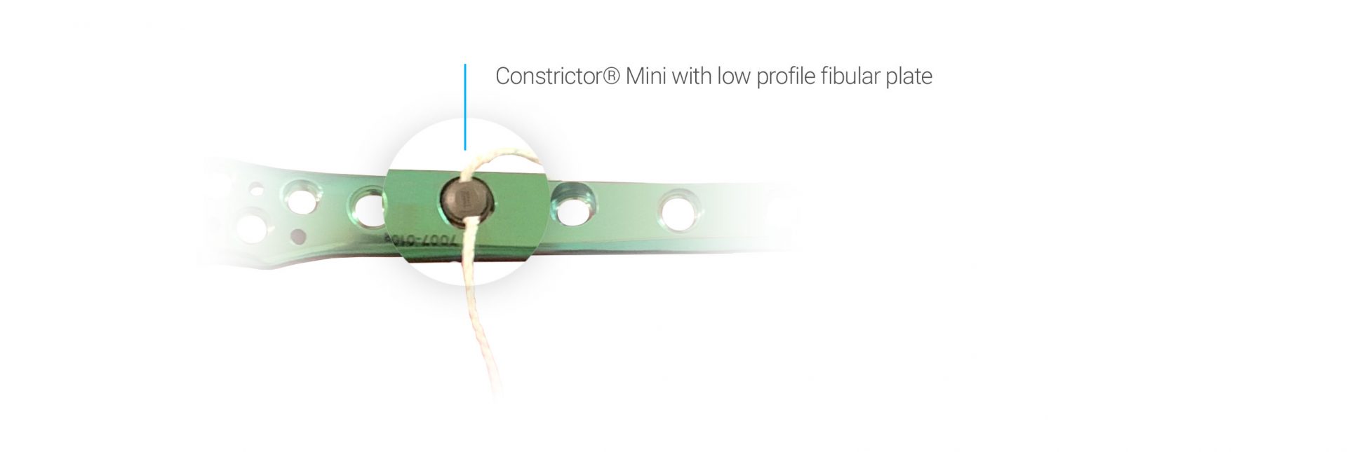 acumed-plate-with-constrictor-mini - Dunamis Medical