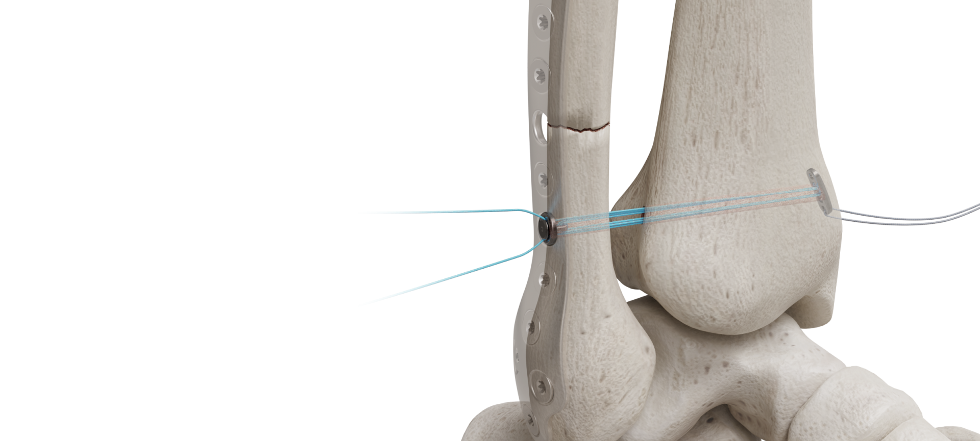 adjustable-button-tech-main - Dunamis Medical
